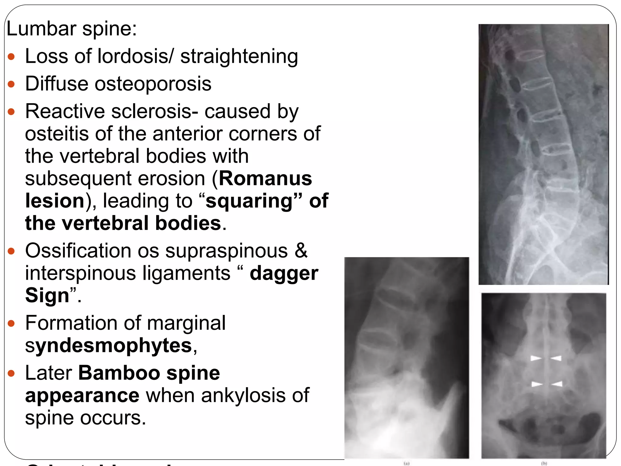Ankylosing spondylitis. (ben) | PPTX