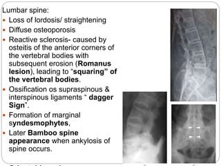 Ankylosing spondylitis. (ben) | PPTX