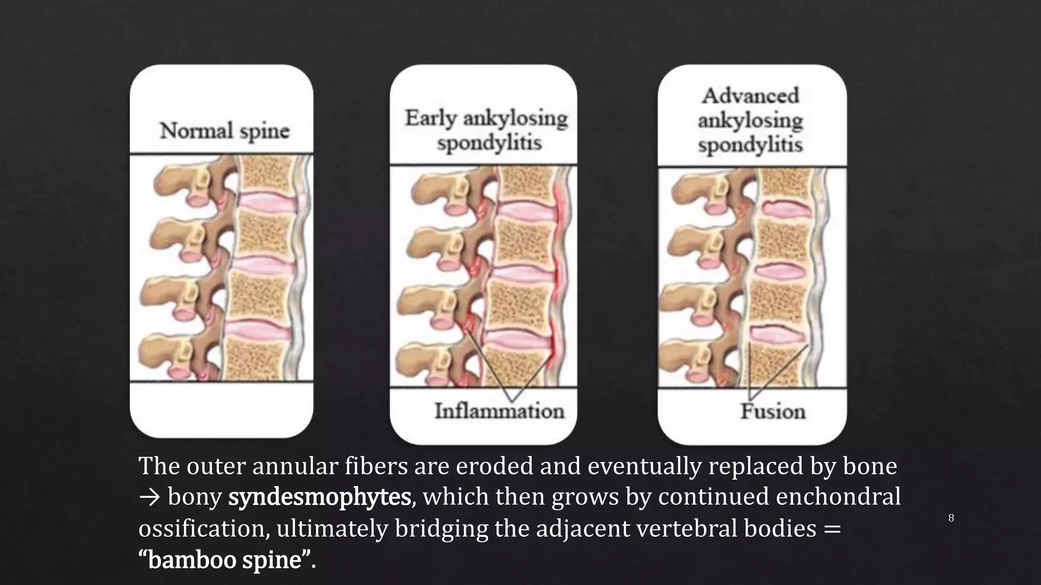 Ankylosing spondylitis rheumatoid arthritis osteoarthritis | PPTX