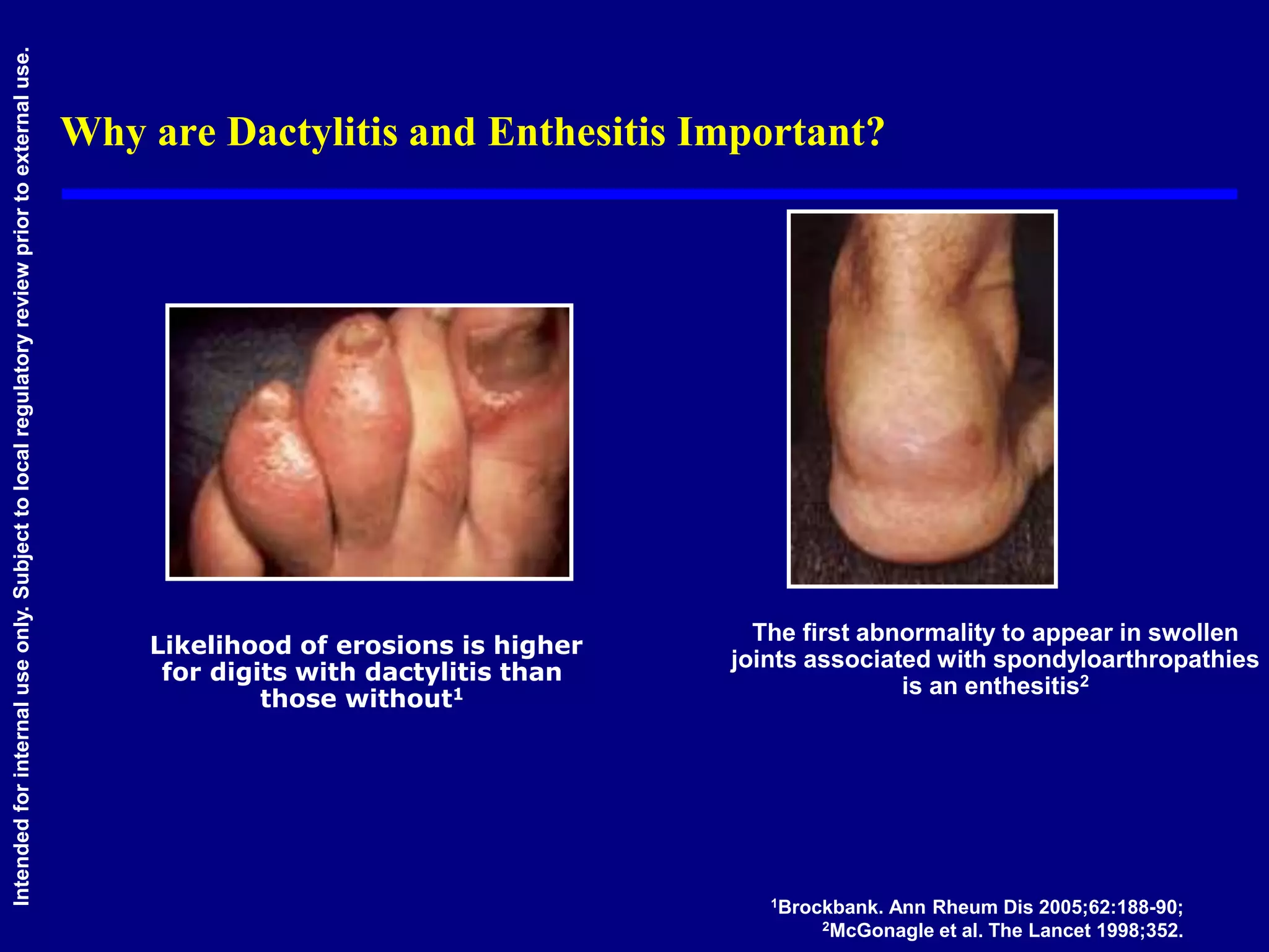 Ankylosing spondylitis | PPTX