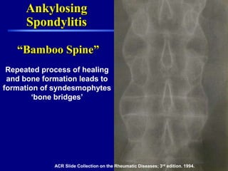 Ankylosing spondylitis | PPTX