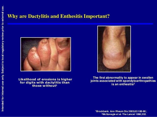 Ankylosing spondylitis