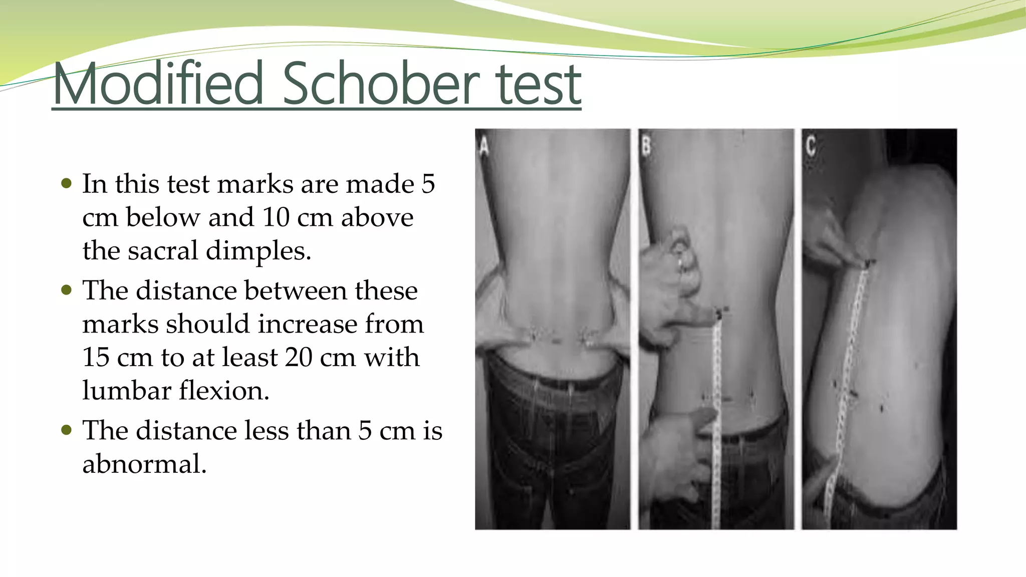Ankylosing spondylitis | PPTX