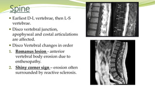 Ankylosing spondylitis | PPTX