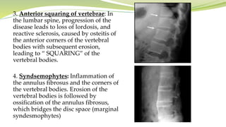 Ankylosing spondylitis | PPTX