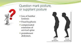 Ankylosing spondylitis | PPT