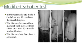 Ankylosing spondylitis | PPT