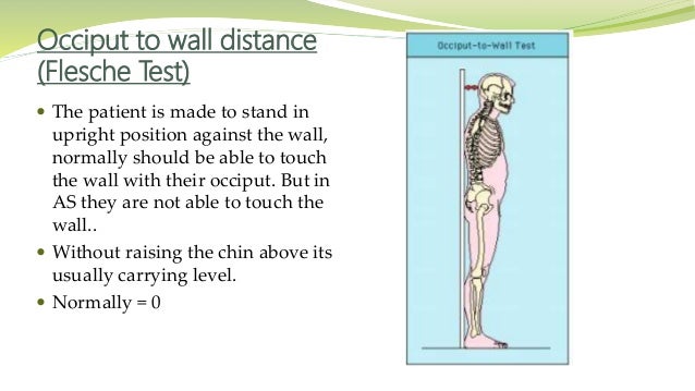 Ankylosing spondylitis