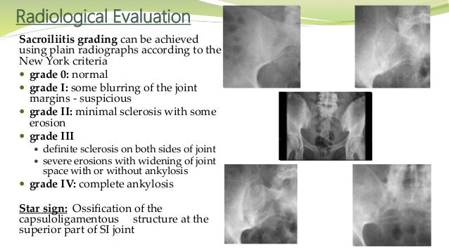Ankylosing spondylitis