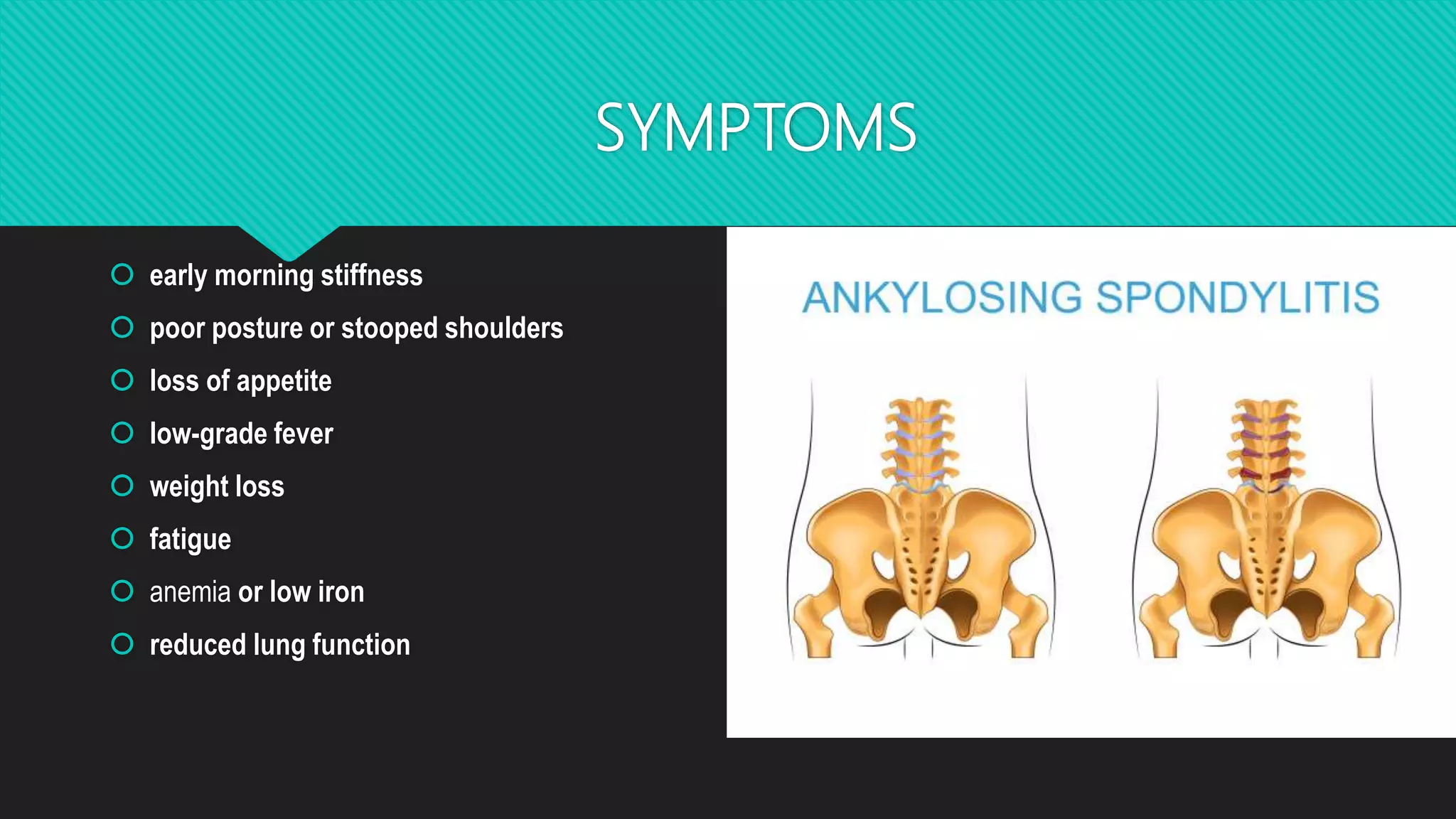Ankylosing spondylitis | PPT