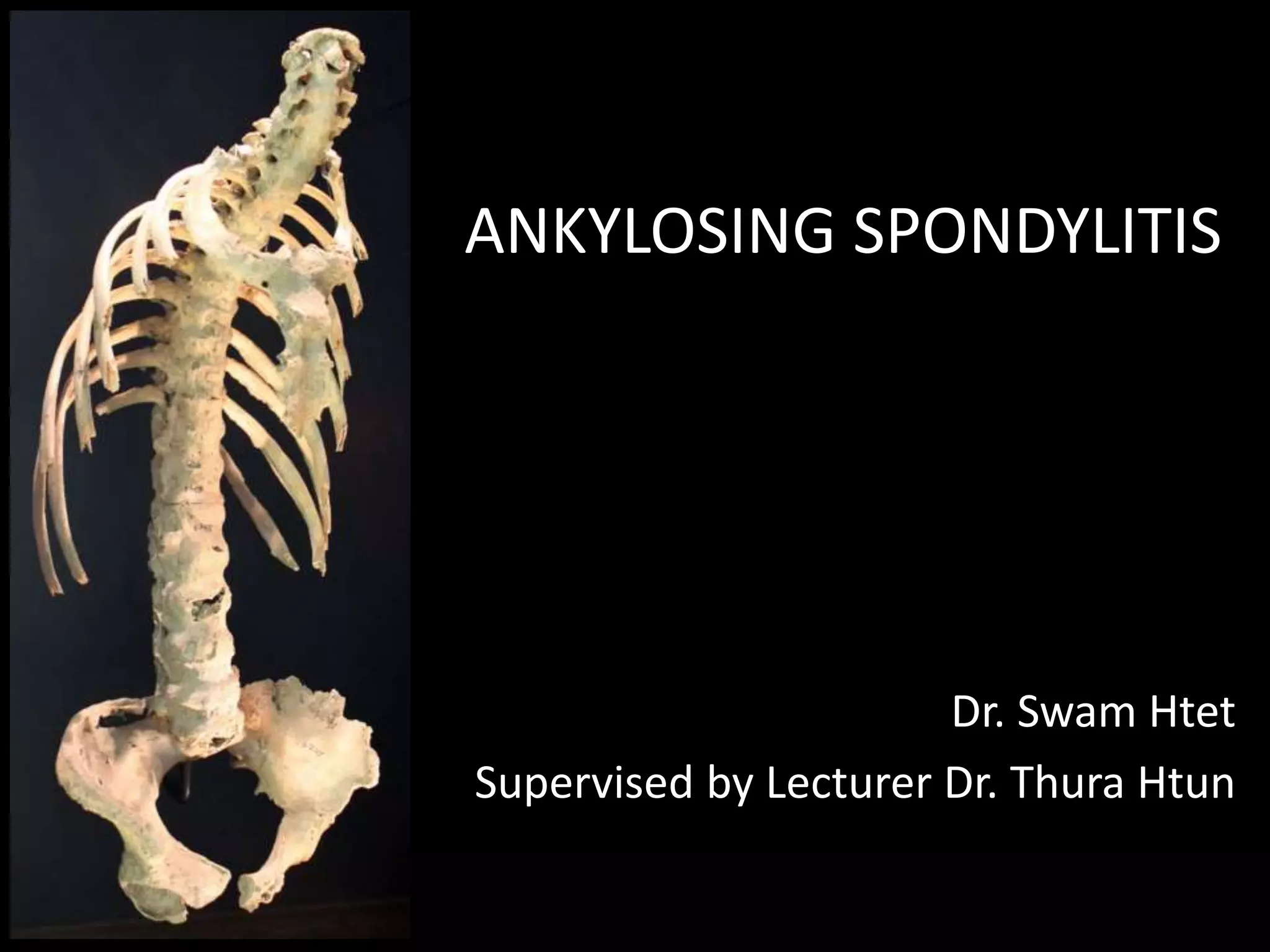 Ankylosing Spondylitis Pptx