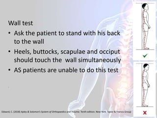 Ankylosing spondylitis | PPTX