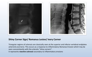 Ankylosing Spondylitis | PPTX
