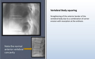Ankylosing Spondylitis | PPT