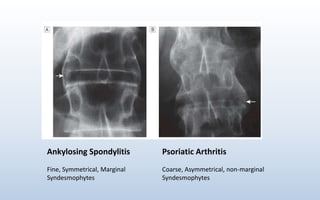Ankylosing Spondylitis | PPT