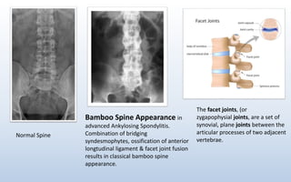 Ankylosing Spondylitis | PPTX