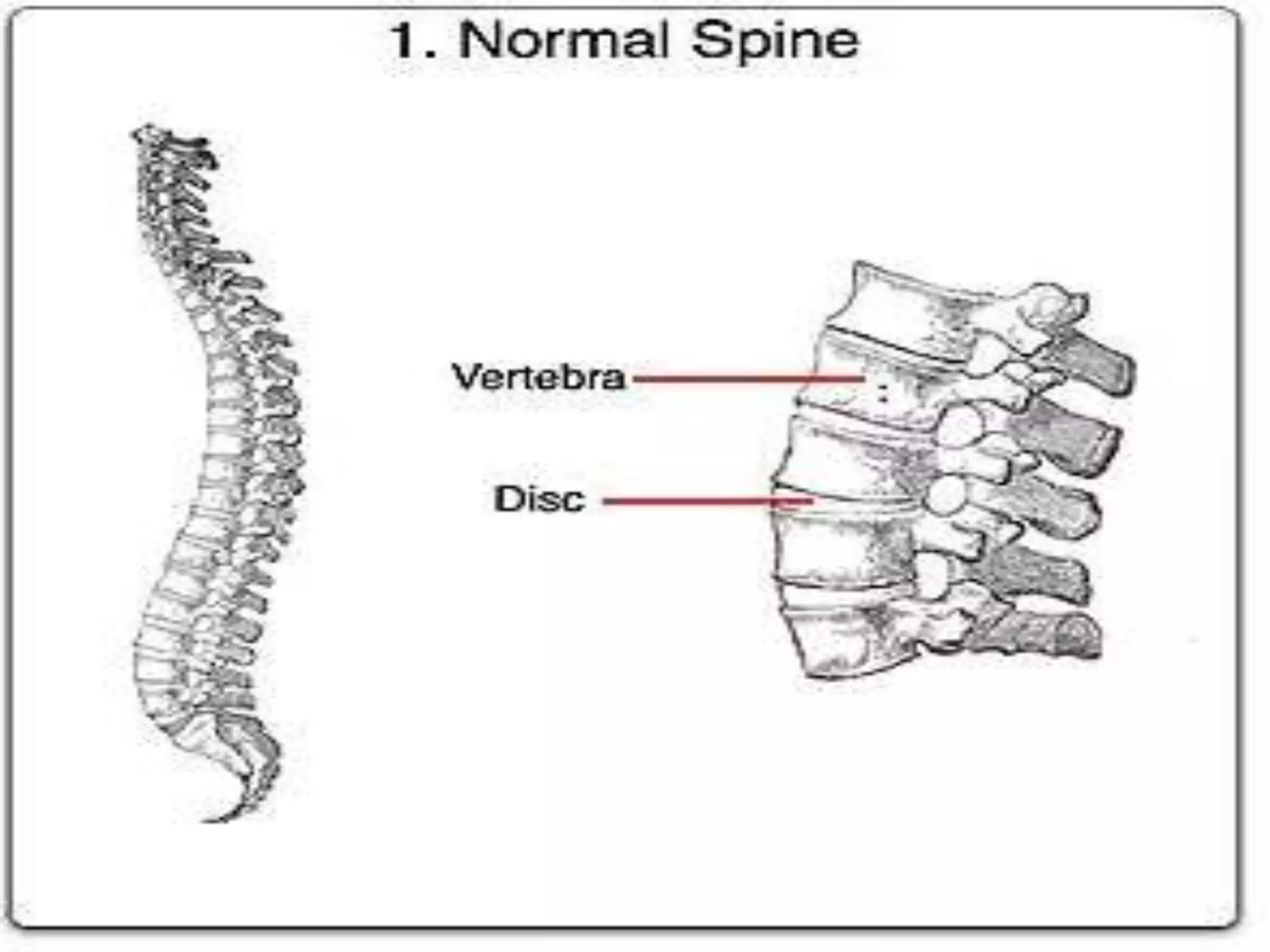 Ankylosing Spondylitis Ppt