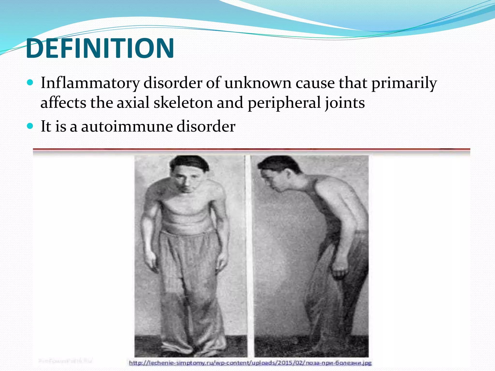 Ankylosing spondylitis | PPT