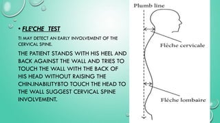 ankylosing spondylitis.pdf | Death, Injury, or Military Conflict ...