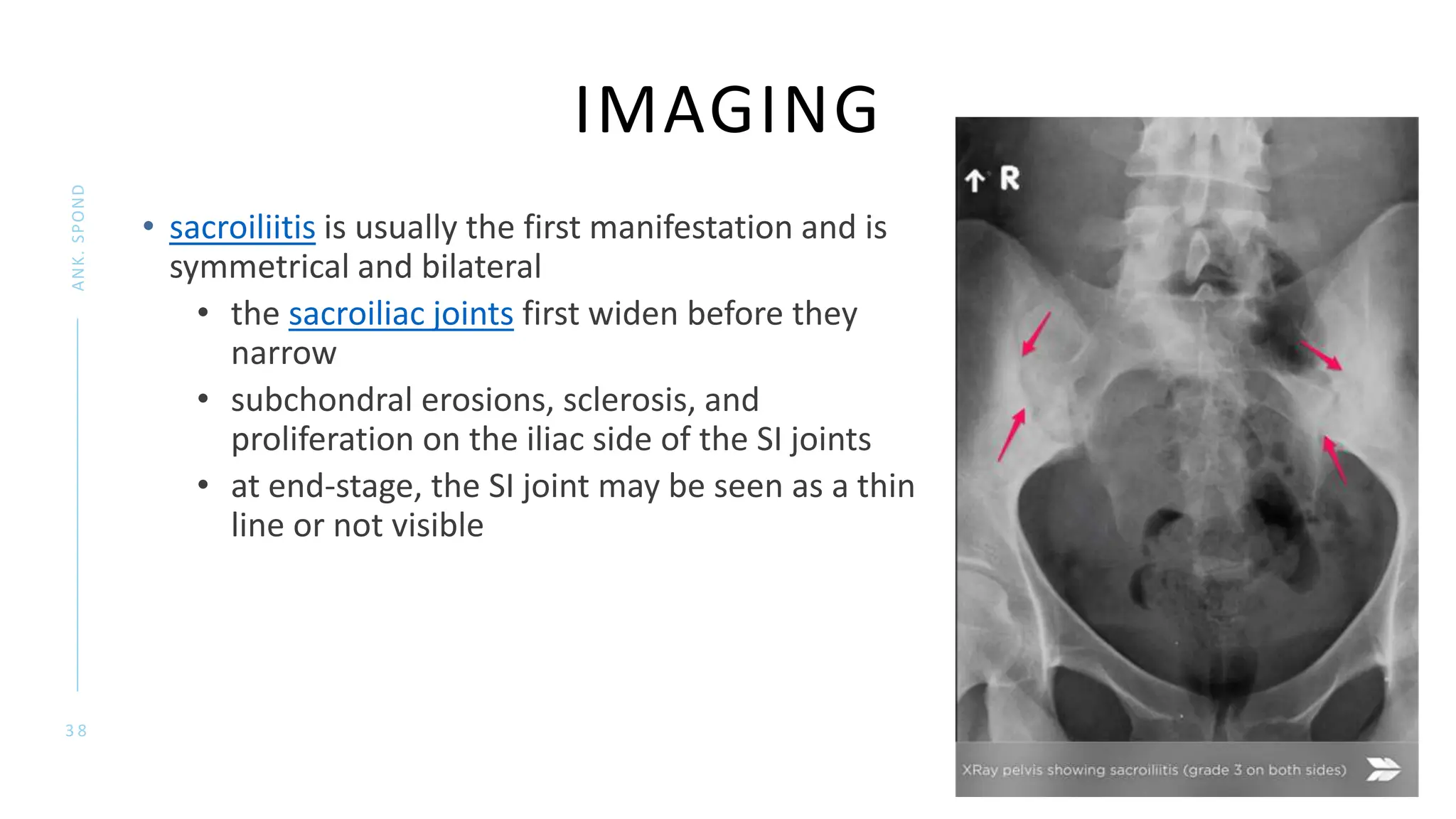 Ankylosing spondylitis.pptx