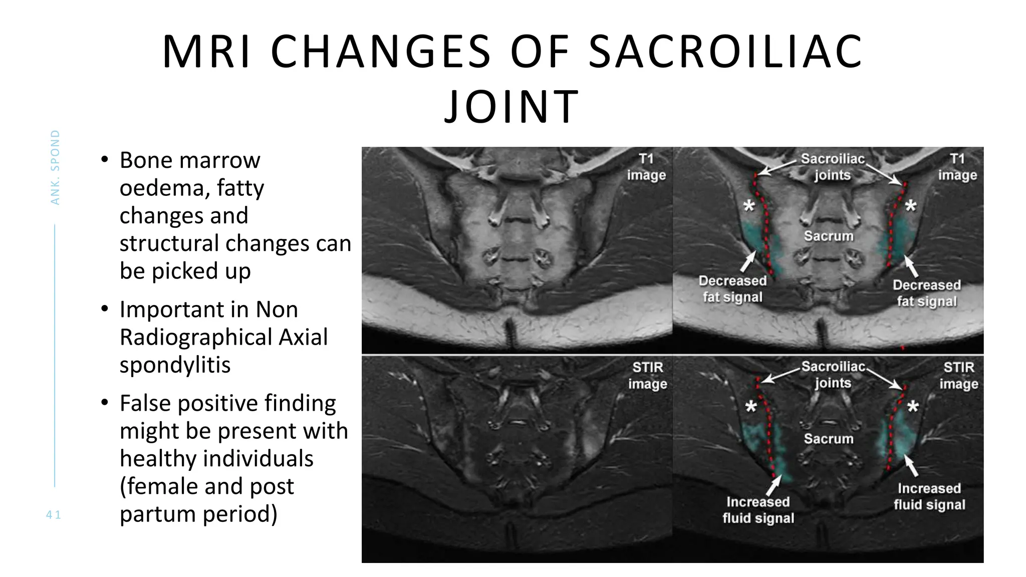 Ankylosing spondylitis.pptx