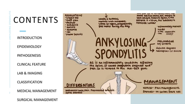 Ankylosing spondylitis.pptx