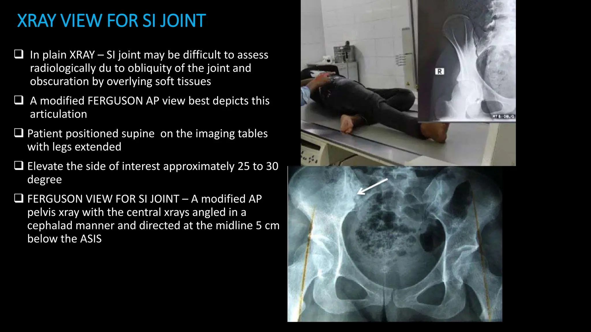 ANKYLOSING SPONDYLITIS RADIOLOGIC MANIFESTATIONS.pptx