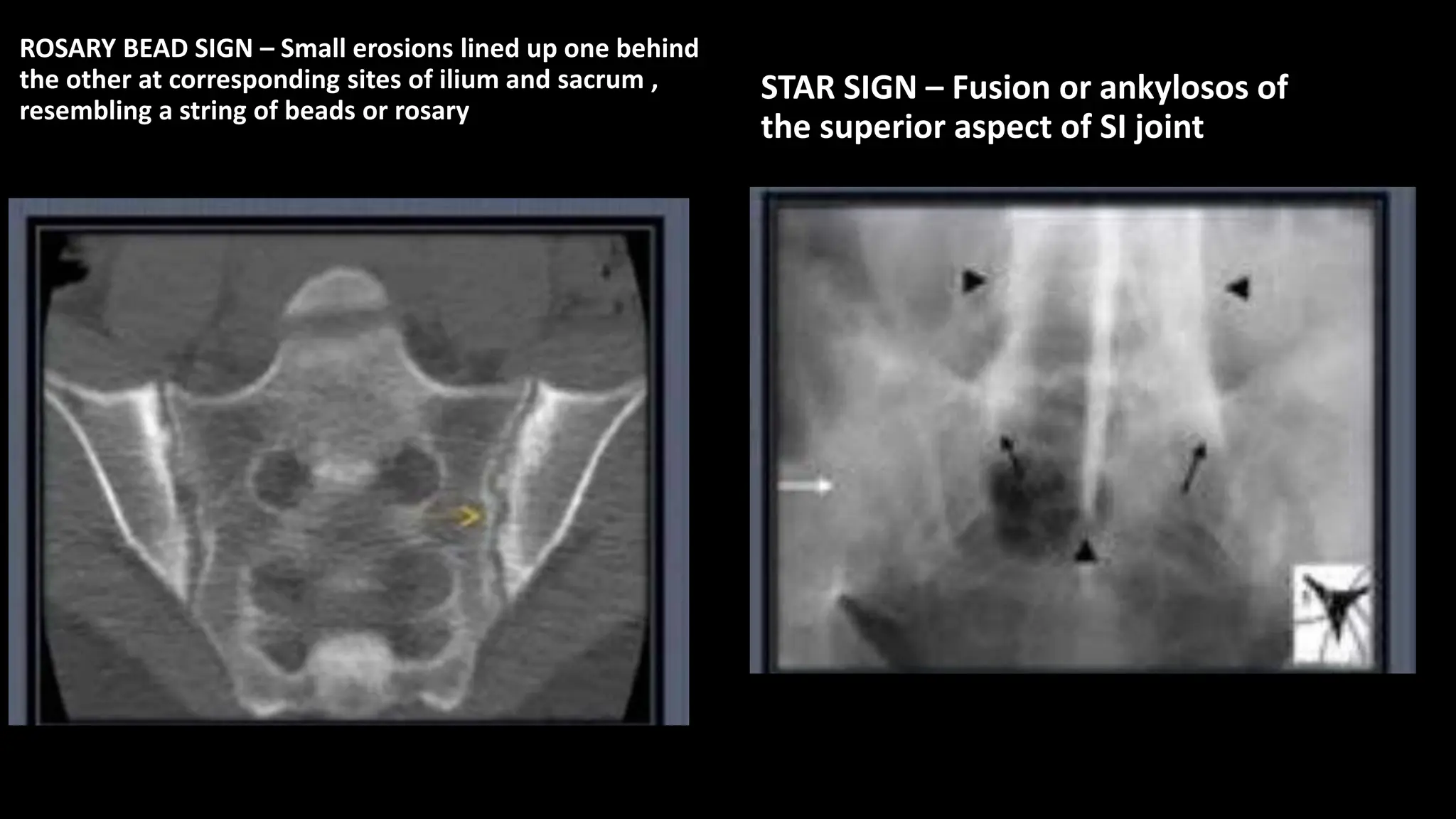 ANKYLOSING SPONDYLITIS RADIOLOGIC MANIFESTATIONS.pptx