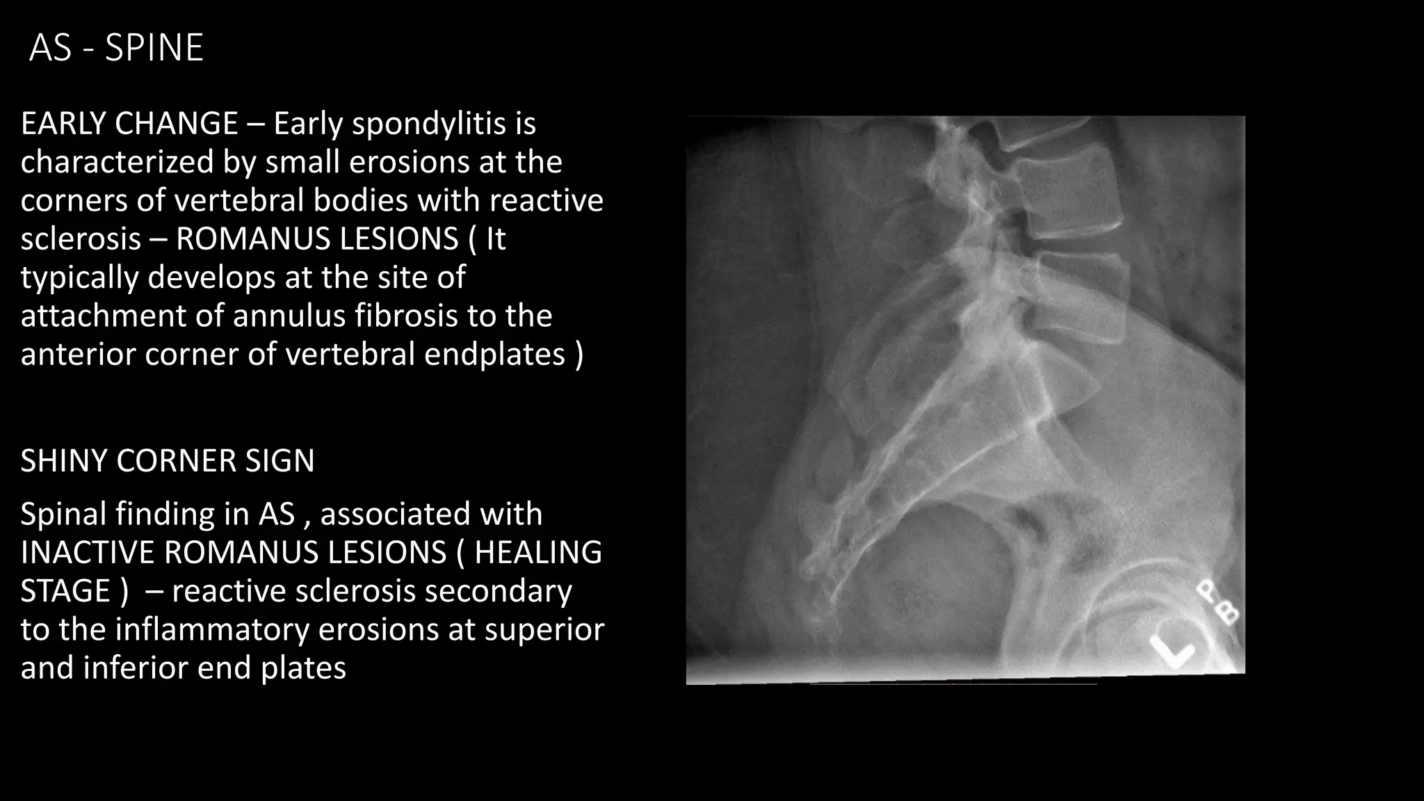 ANKYLOSING SPONDYLITIS RADIOLOGIC MANIFESTATIONS.pptx