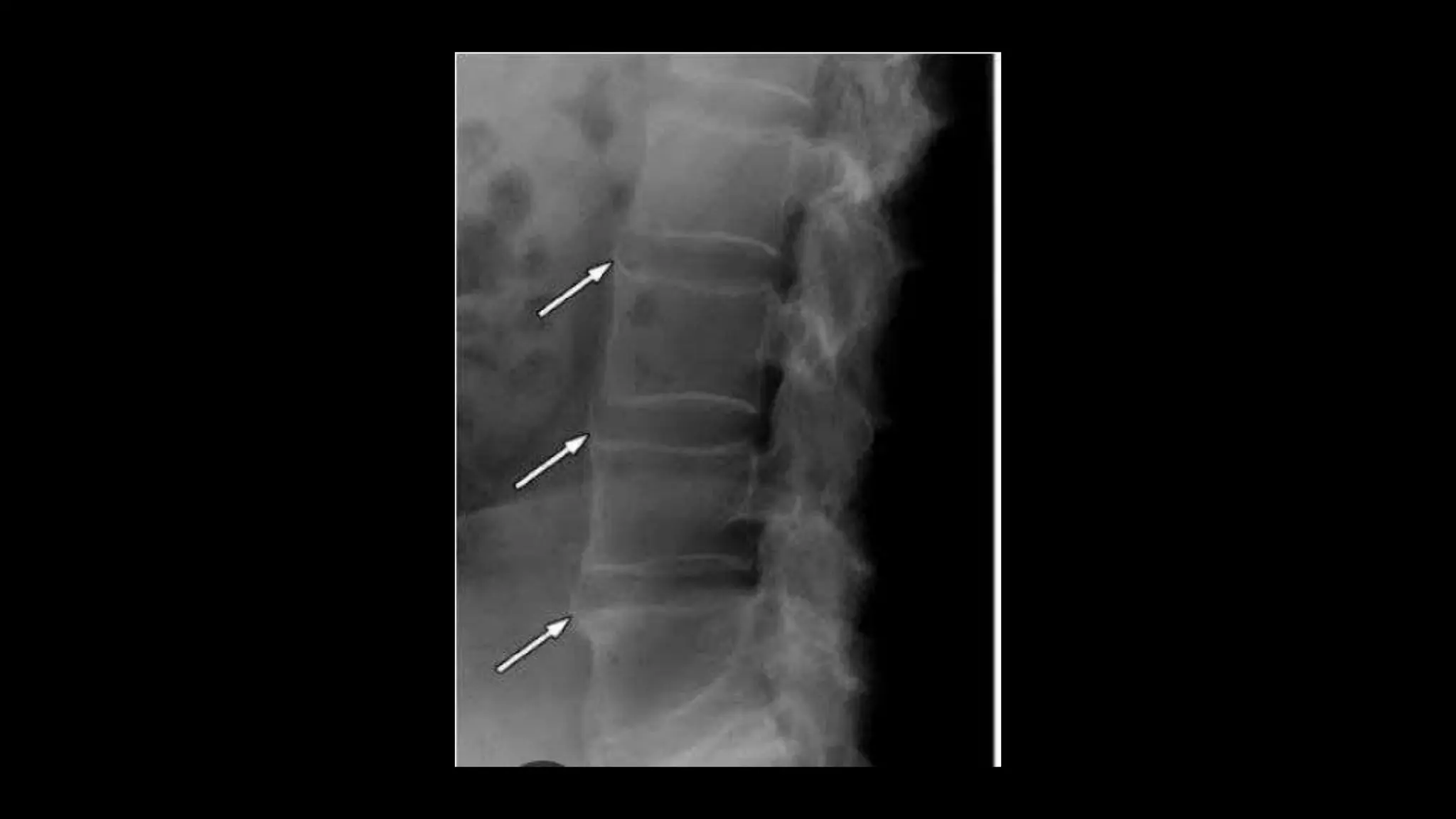 ANKYLOSING SPONDYLITIS RADIOLOGIC MANIFESTATIONS.pptx