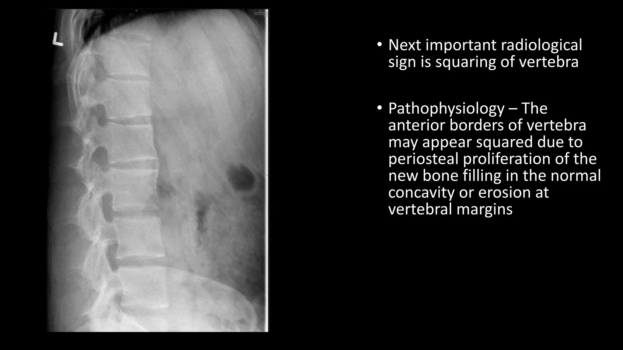 ANKYLOSING SPONDYLITIS RADIOLOGIC MANIFESTATIONS.pptx