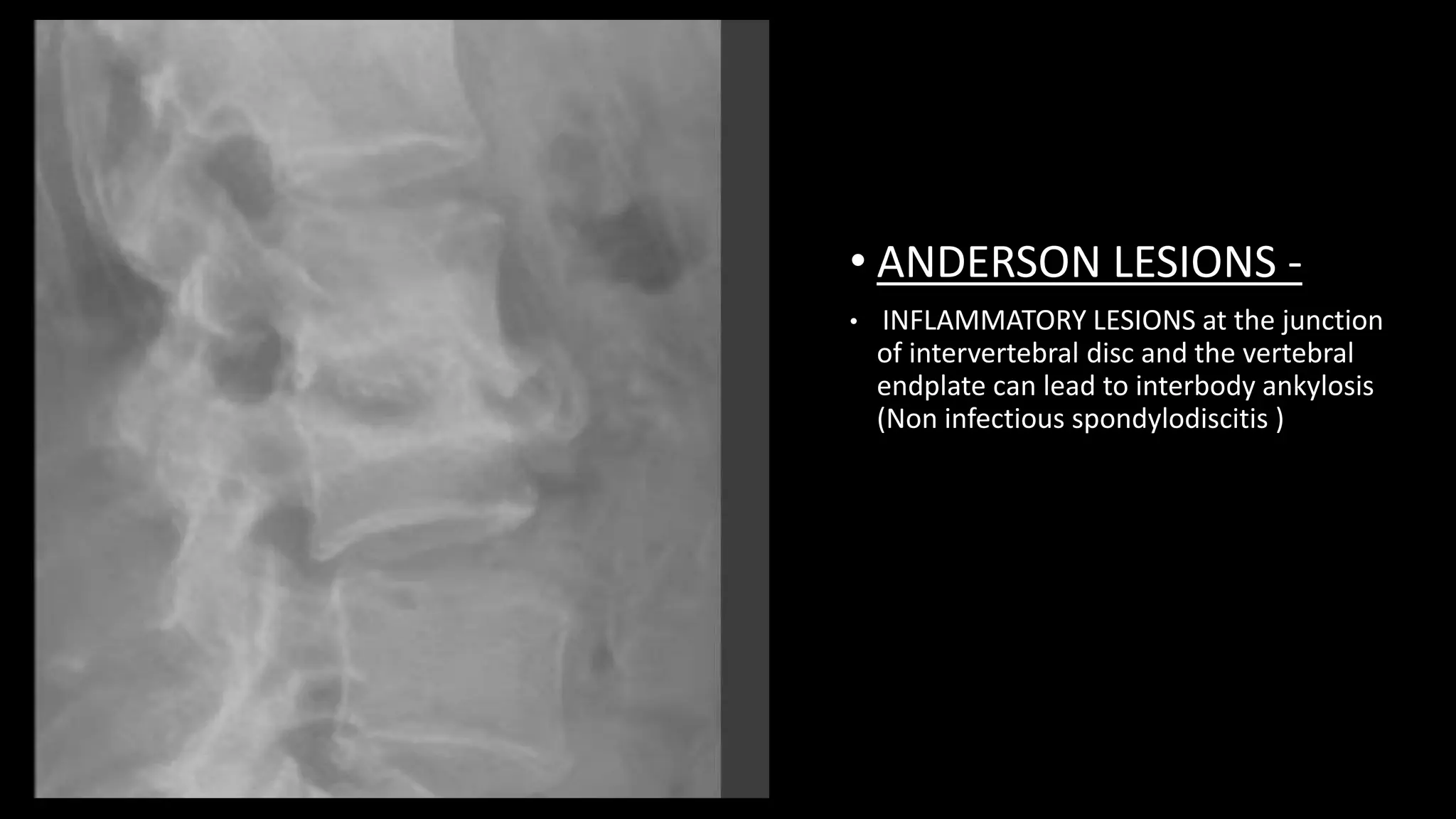 ANKYLOSING SPONDYLITIS RADIOLOGIC MANIFESTATIONS.pptx