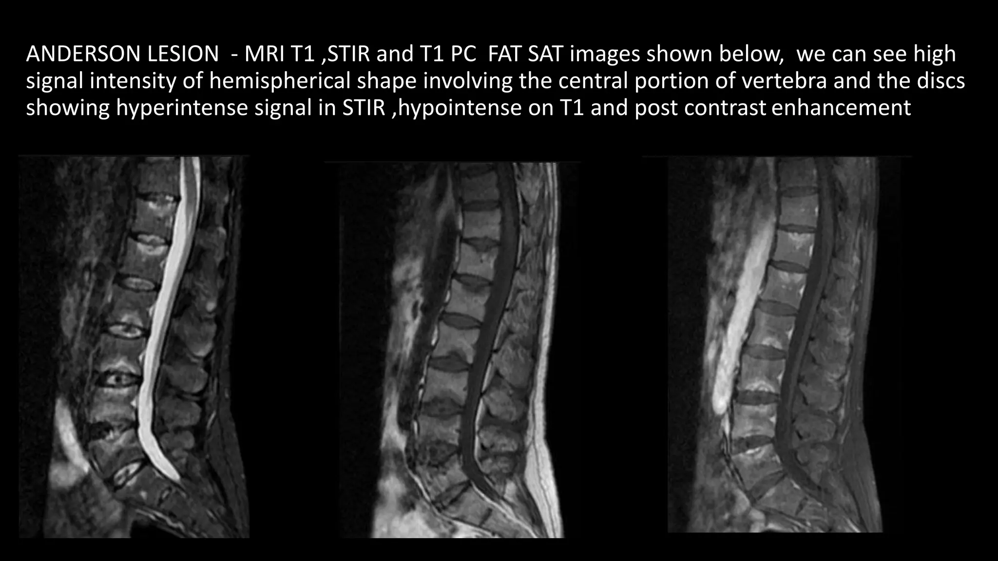 ANKYLOSING SPONDYLITIS RADIOLOGIC MANIFESTATIONS.pptx