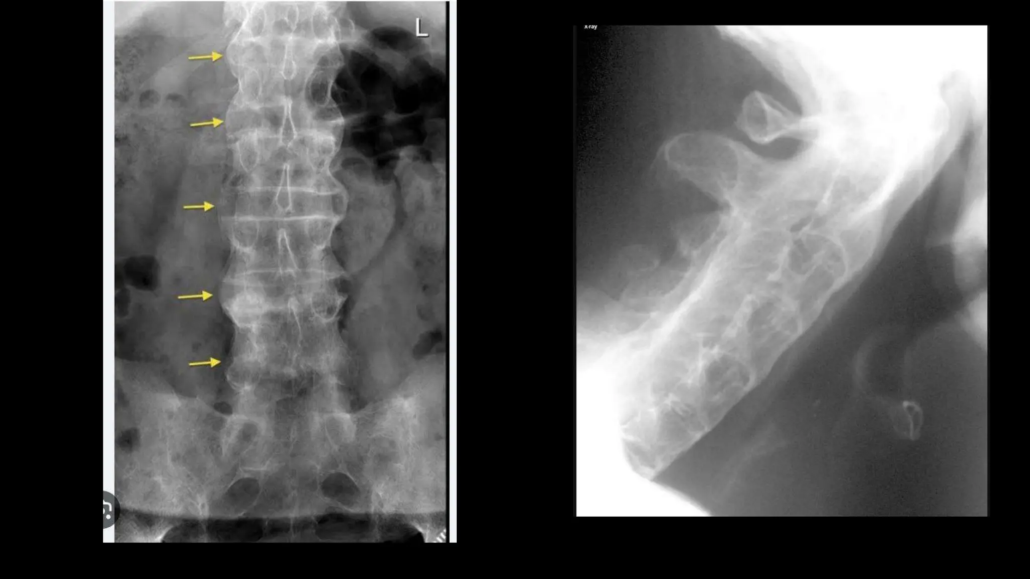 ANKYLOSING SPONDYLITIS RADIOLOGIC MANIFESTATIONS.pptx