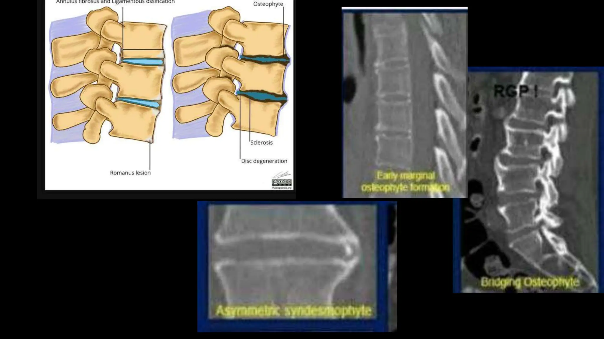 ANKYLOSING SPONDYLITIS RADIOLOGIC MANIFESTATIONS.pptx