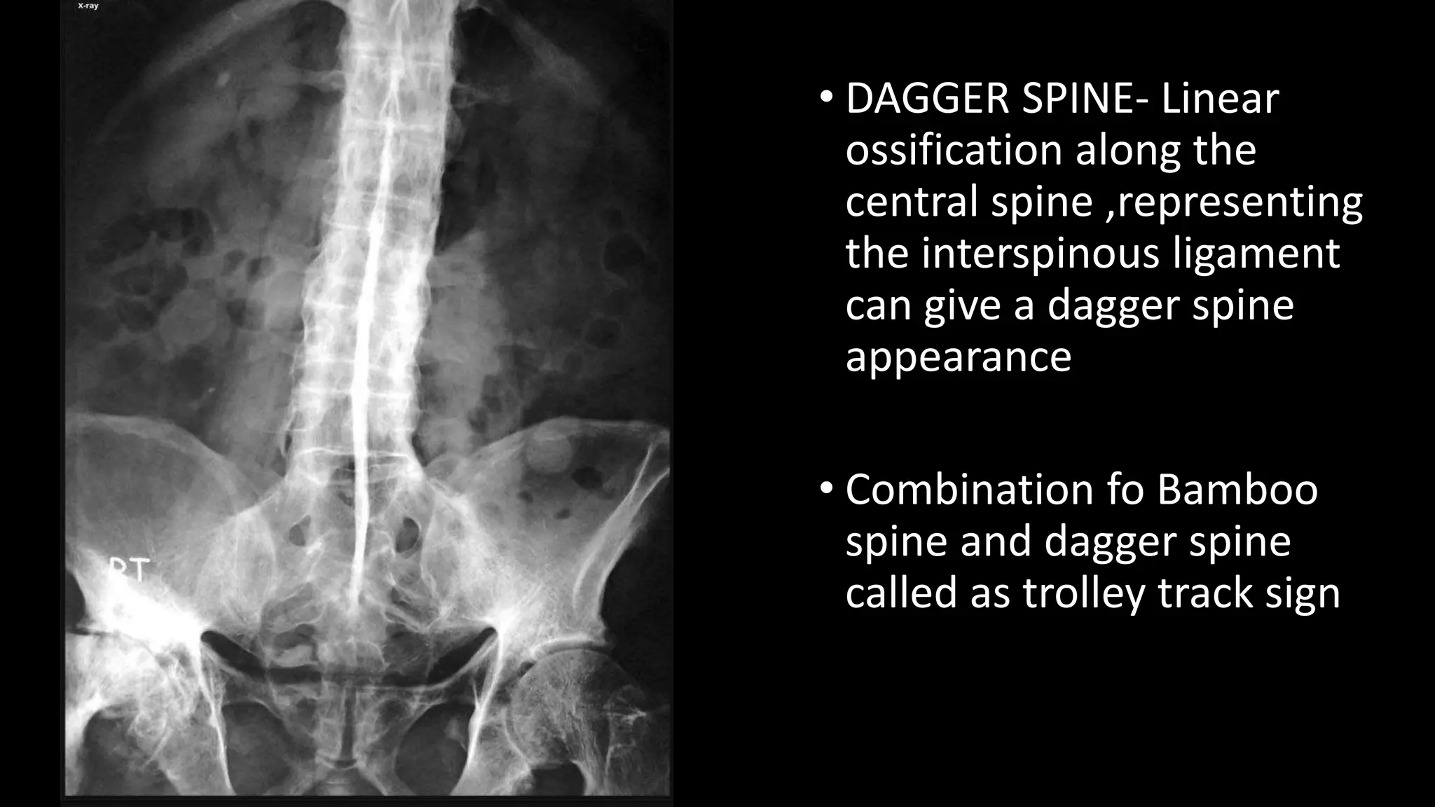 ANKYLOSING SPONDYLITIS RADIOLOGIC MANIFESTATIONS.pptx