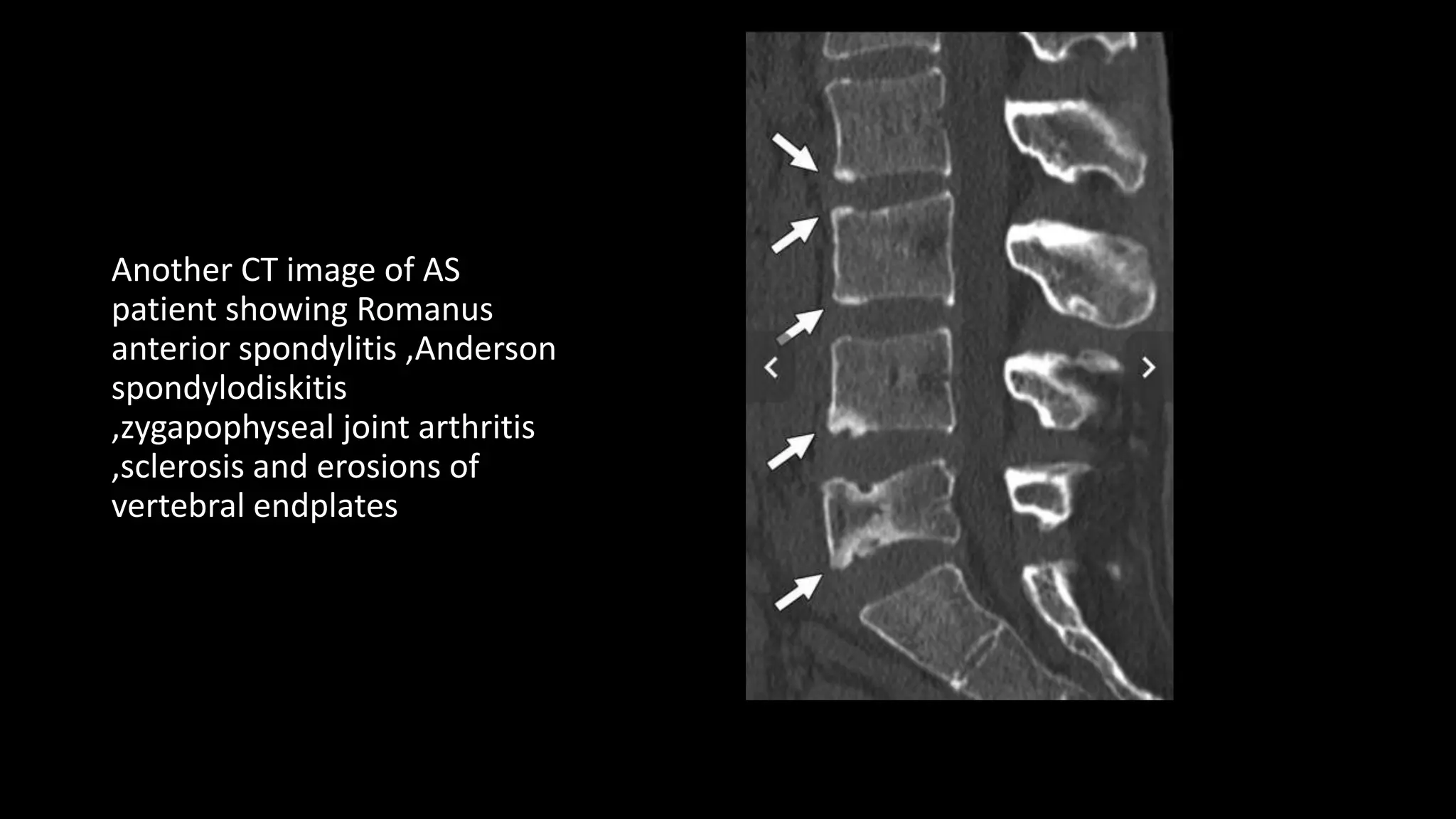ANKYLOSING SPONDYLITIS RADIOLOGIC MANIFESTATIONS.pptx