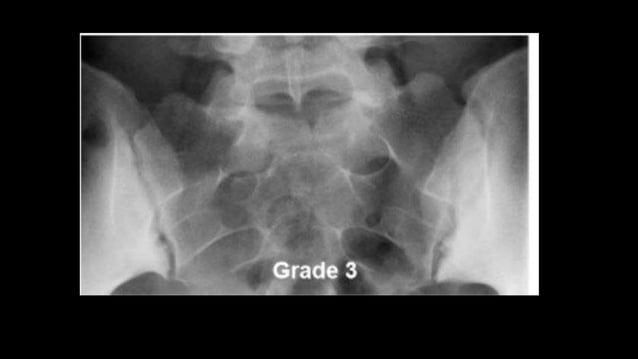 ANKYLOSING SPONDYLITIS RADIOLOGIC MANIFESTATIONS.pptx