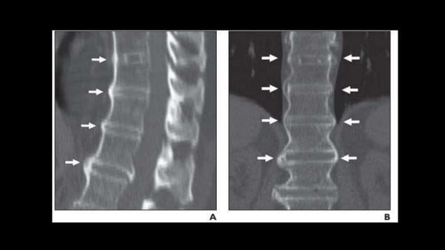 ANKYLOSING SPONDYLITIS RADIOLOGIC MANIFESTATIONS.pptx