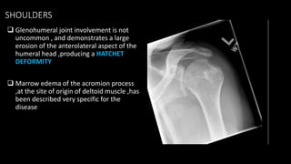 ANKYLOSING SPONDYLITIS RADIOLOGIC MANIFESTATIONS.pptx