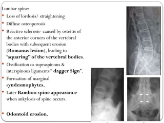 ankylosing spondylitis ankylosis sp.pptx