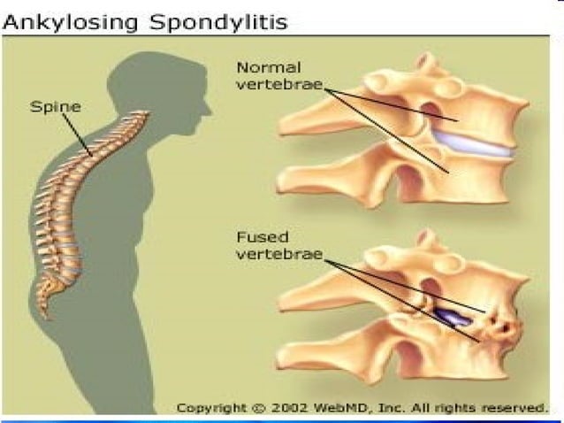 ankylosing spondylitis ankylosis sp.pptx