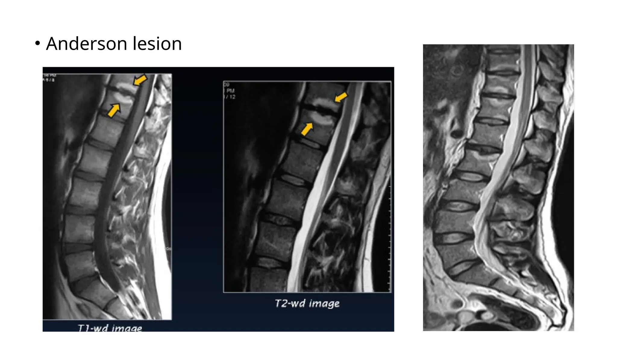 ankylosing spondylitis.pptx236599999999999 | PPTX
