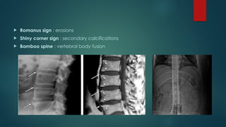 ANKYLOSING SPONDYLITIS.pptx medical terminology | PPT