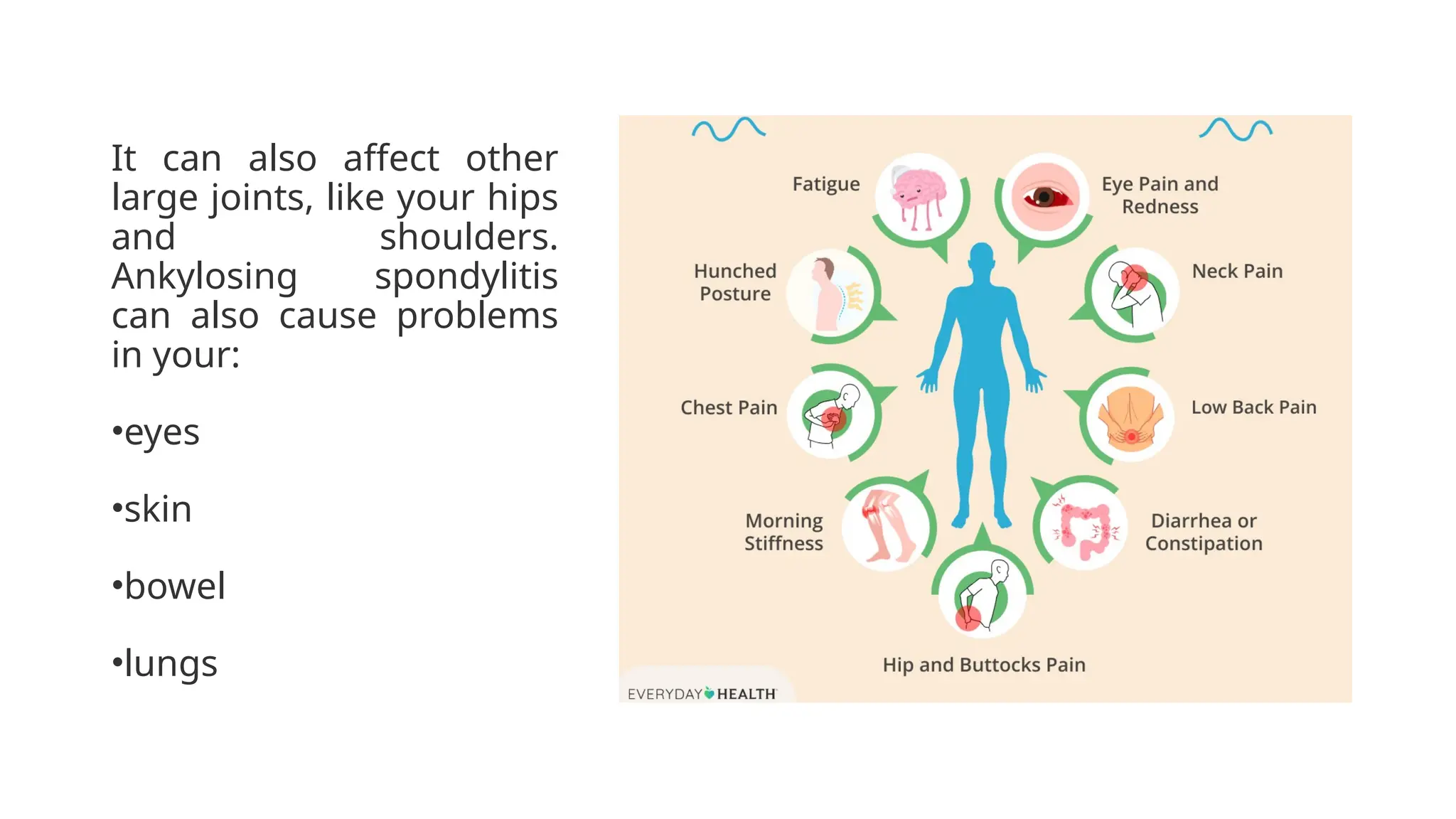 Ankylosing Spondylitis (Assessment and Physiotherapy Management) | PPTX