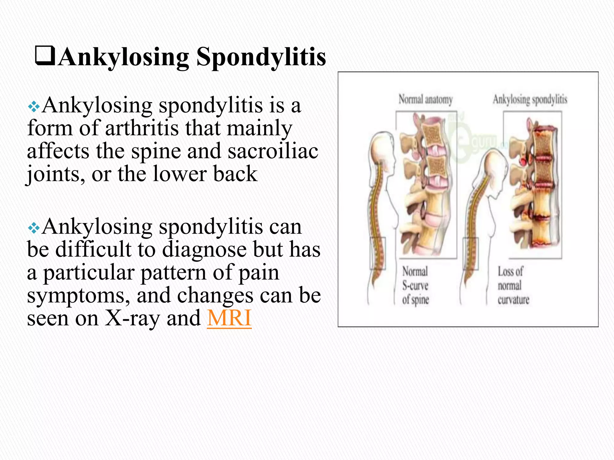 Ankylosing spondylitis,Causes,symptoms,diagnosis,management | PPTX