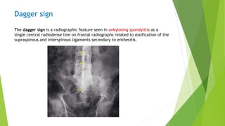 Ankylosing spondylitis and psoriatic arthritis | PPTX