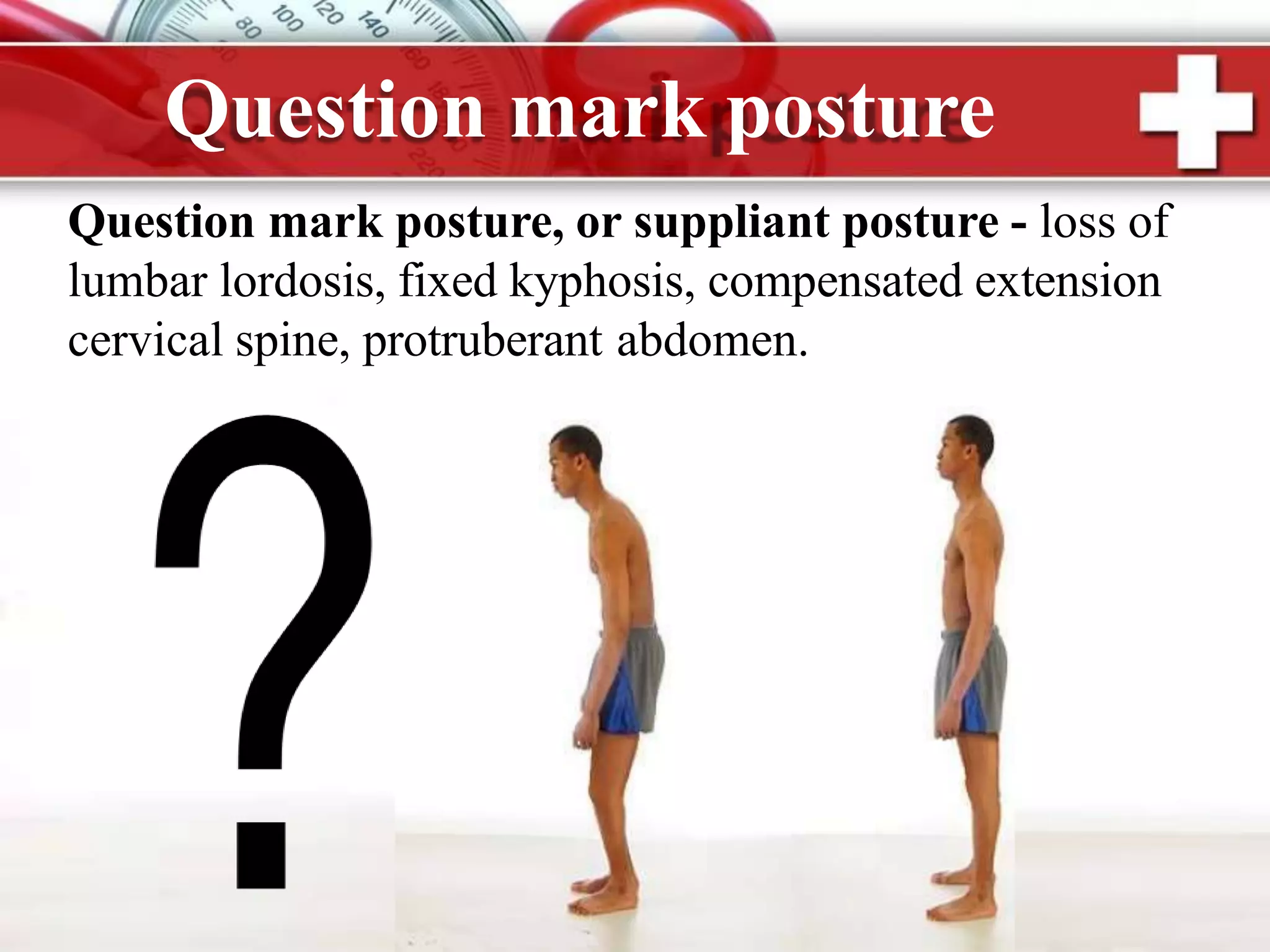 Ankylosing spondylitis by dr ashutosh | PPT