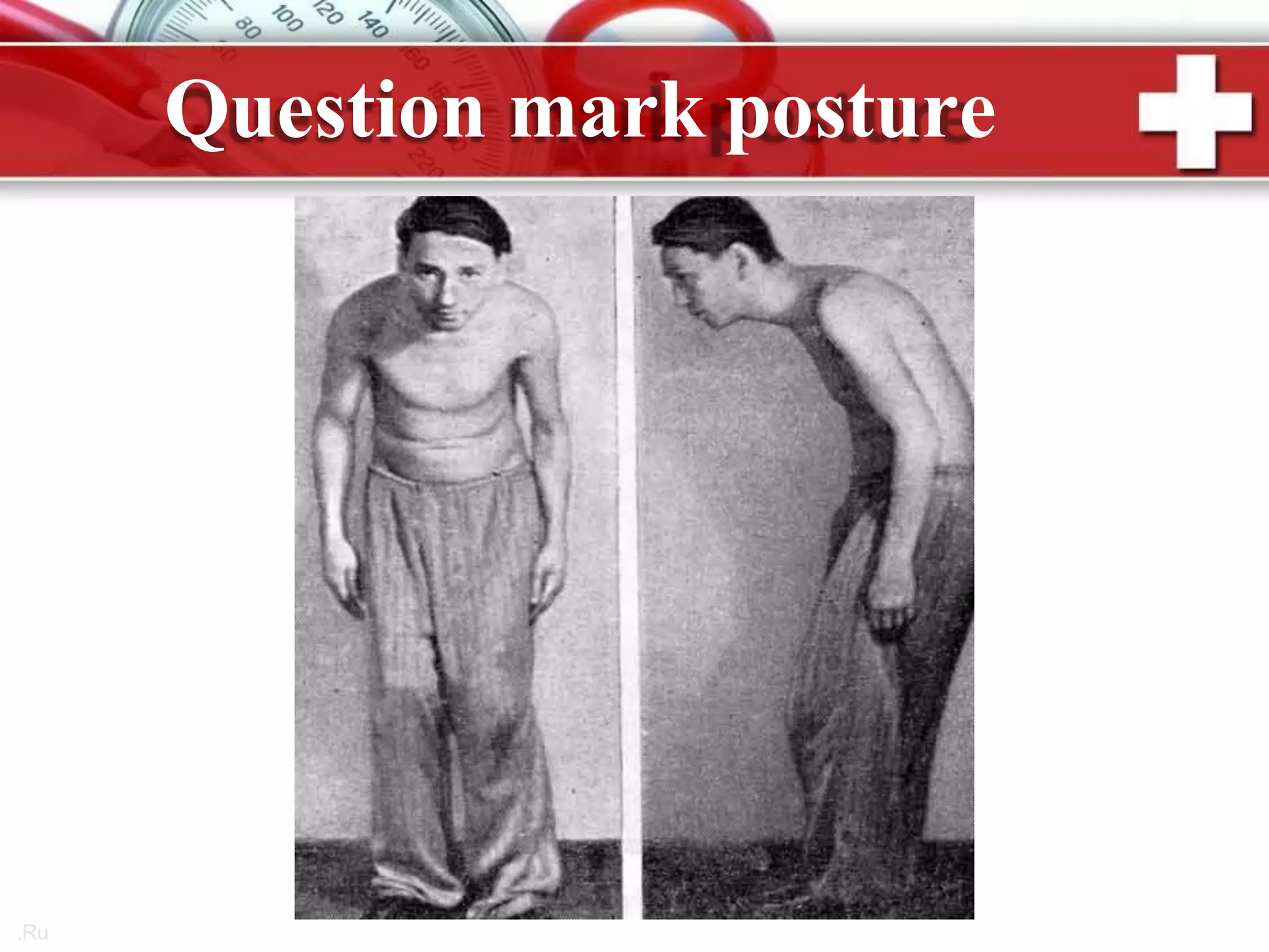 Ankylosing spondylitis by dr ashutosh | PPT