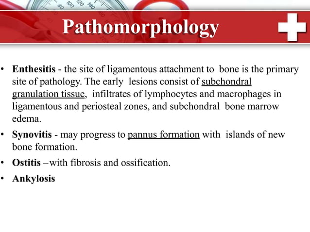 Ankylosing spondylitis by dr ashutosh | PPT